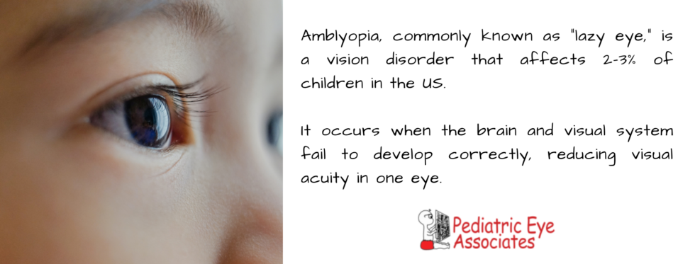How Eye Patching Works for Children with Amblyopia?